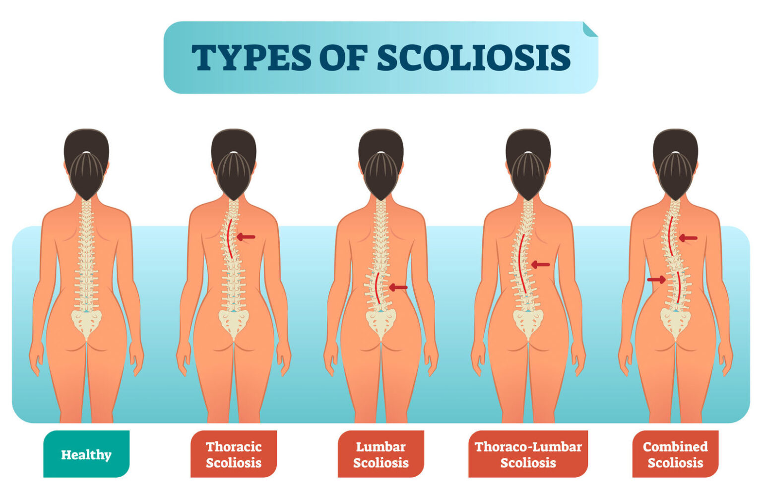 Apa Itu Scoliosis? Punca, Simptom & Cara Rawatannya - Portal Kesihatan No.1