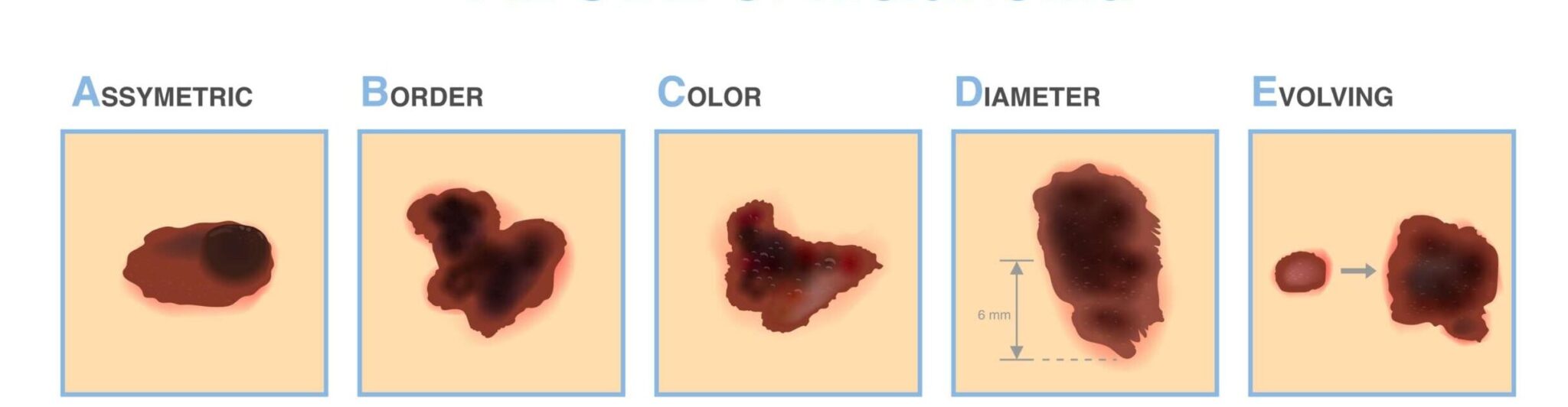 Early Signs of Skin Cancer - Portal Kesihatan No.1